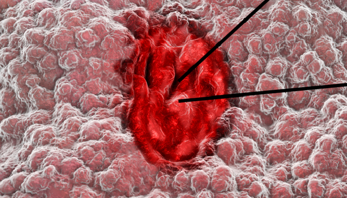 Ülser hastaları nasıl beslenmeli? Ülser olanlar ne yememeli? (Ülser ...