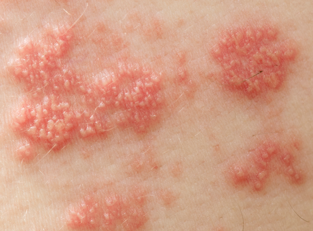 Zona: Nedenleri, belirtileri, tedavisi - Sağlık Haberleri