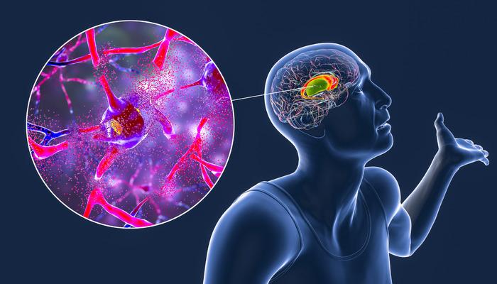 Huntington hastalığı nedir? Huntington hastalığı belirtileri ve ...