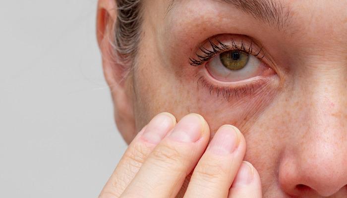 Üveit nedir, tehlikeli midir? Üveit belirtileri ve tedavisi - Sağlık ...