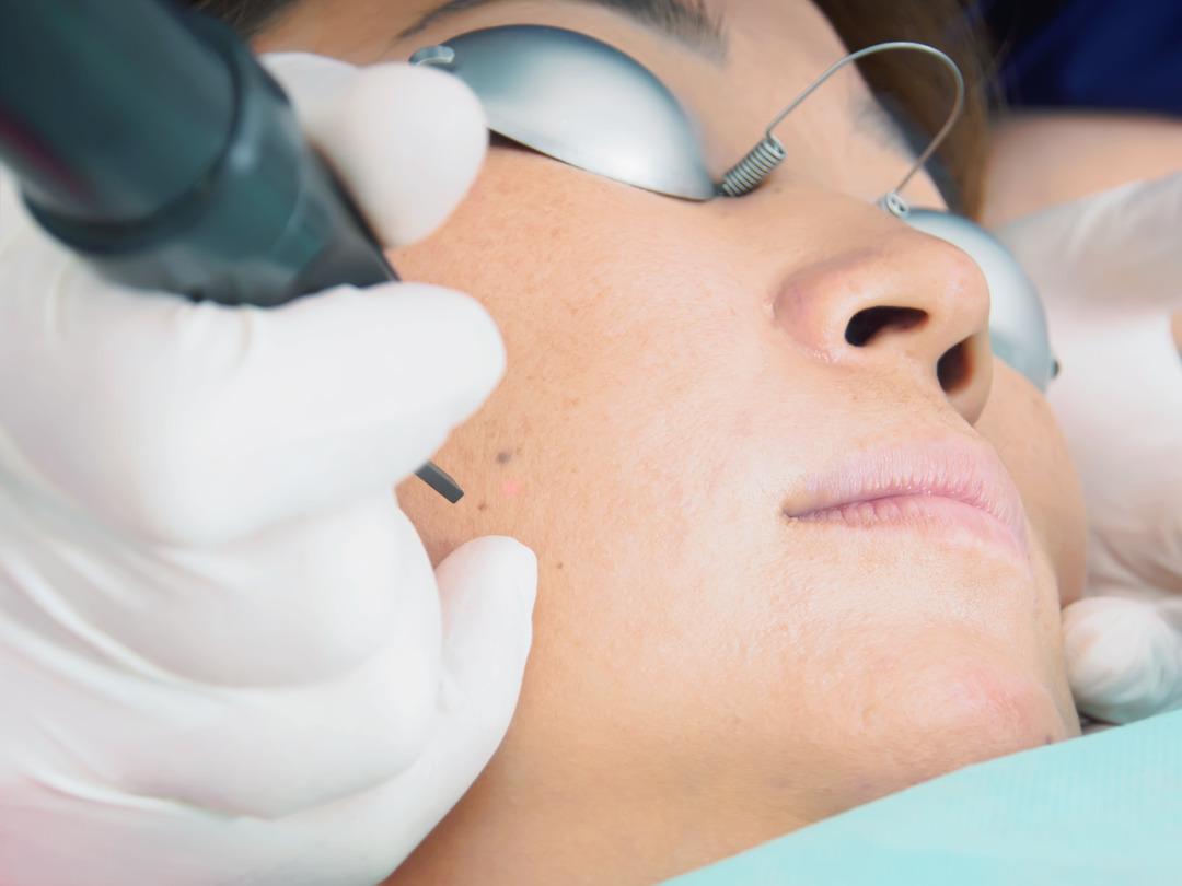 Q-Switch lazer nedir, ne işe yarar? Q-Switch lazer nasıl uygulanır?