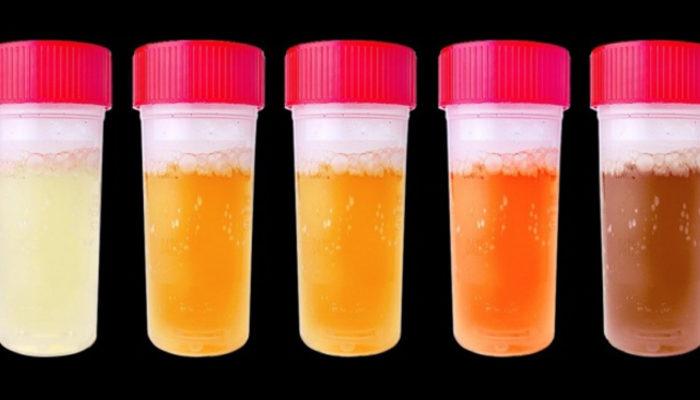 İdrar rengi sağlığınız hakkında önemli bilgiler veriyor